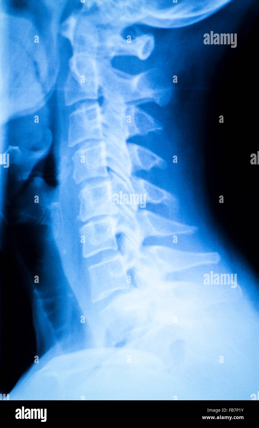 Painful neck and spine injury x-ray scan Traumatology and orthopedics ...