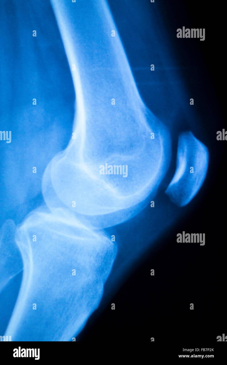 Knee joint meniscus x-ray test scan results photo showing injury and ...