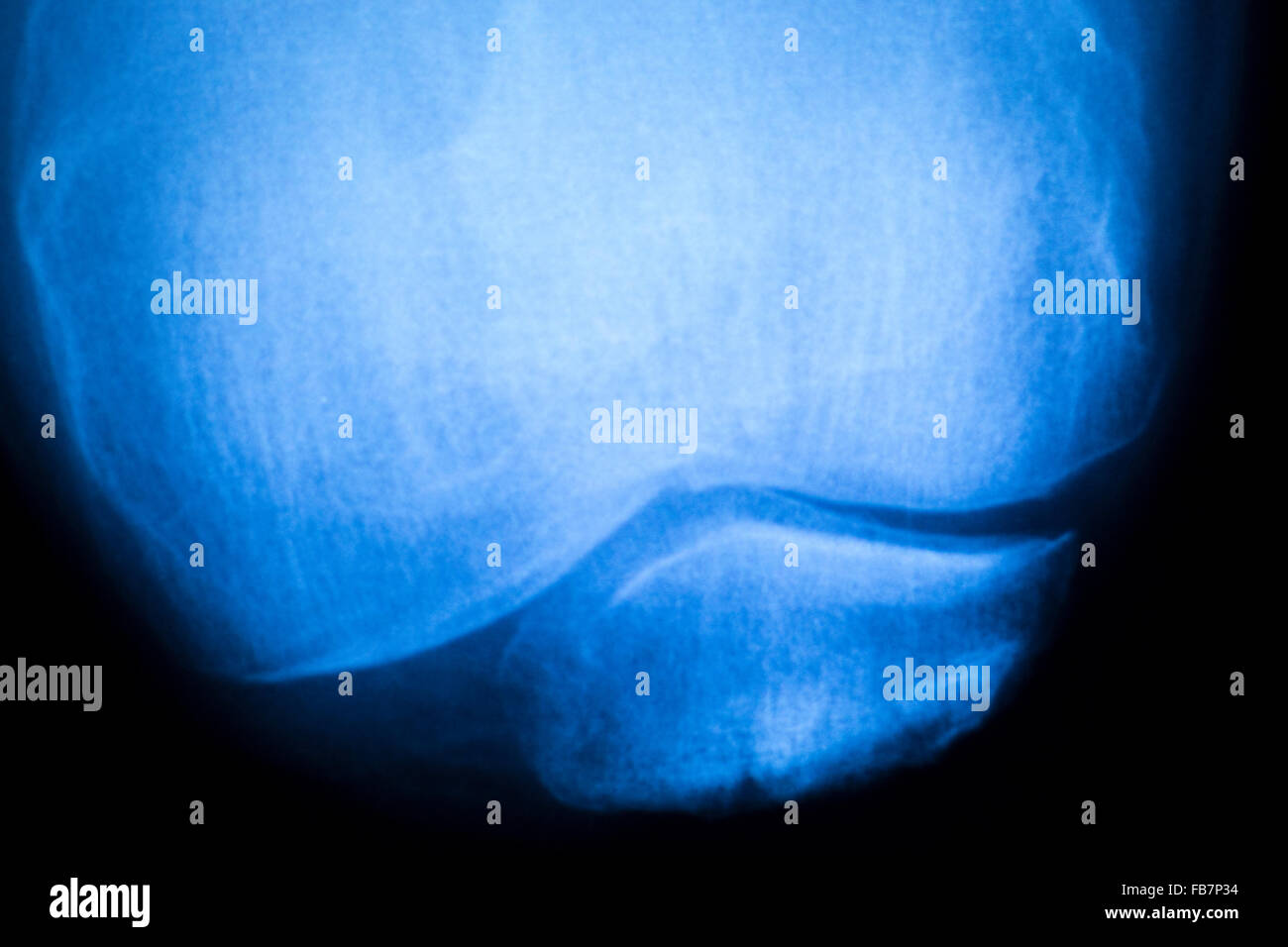 Knee joint meniscus x-ray test scan results photo showing injury and ...