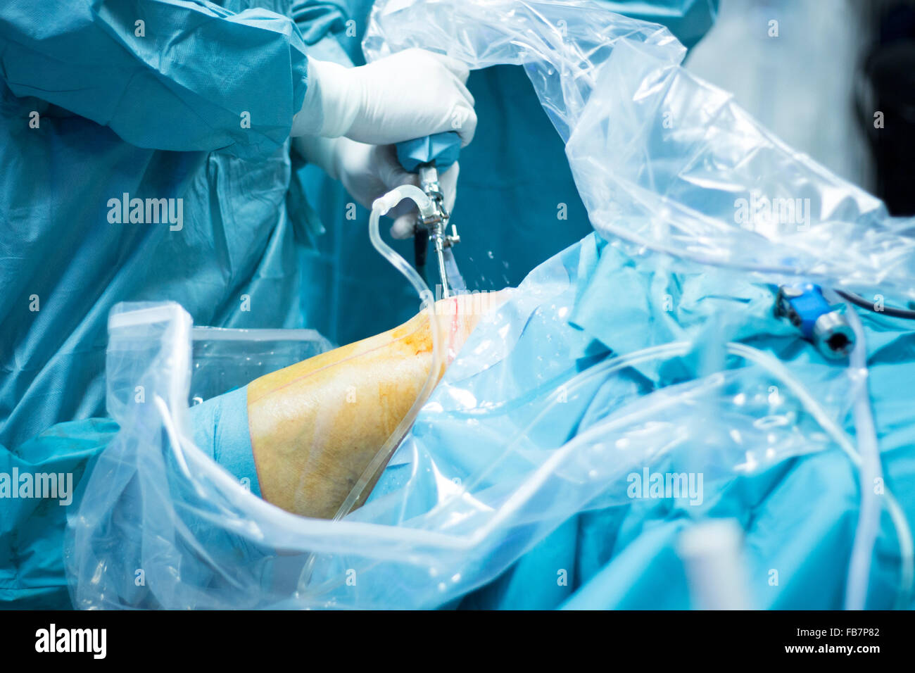 Knee arthroscopy orthopedic surgery operation in hospital operating ...