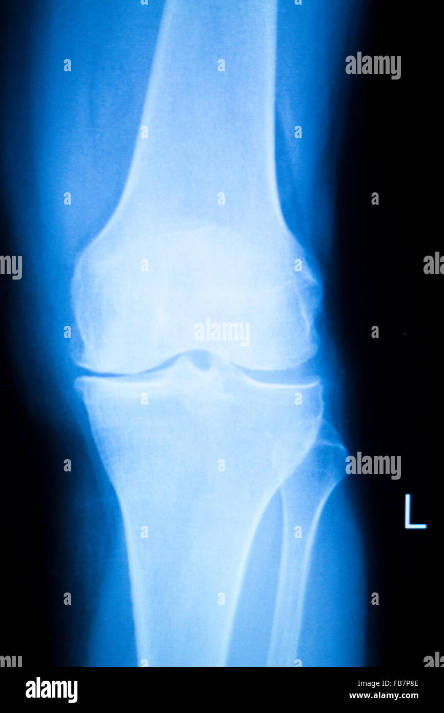 Knee joint meniscus x-ray test scan results photo showing injury and ...