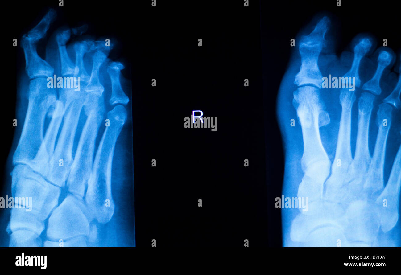 Foot and toes injury x-ray scan orthopedics and Traumatology radiology ...