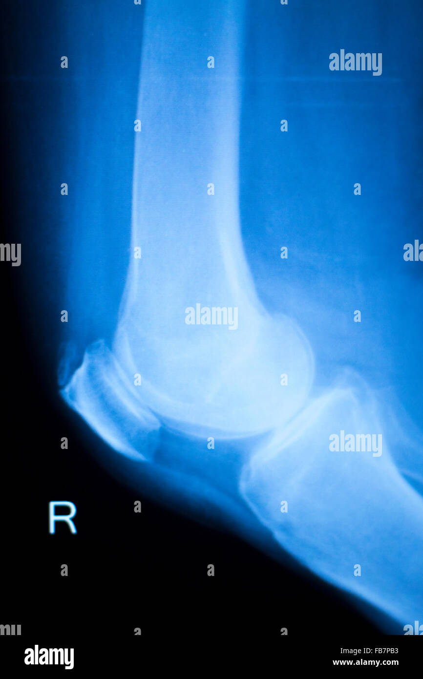 Knee joint meniscus x-ray test scan results photo showing injury and ...