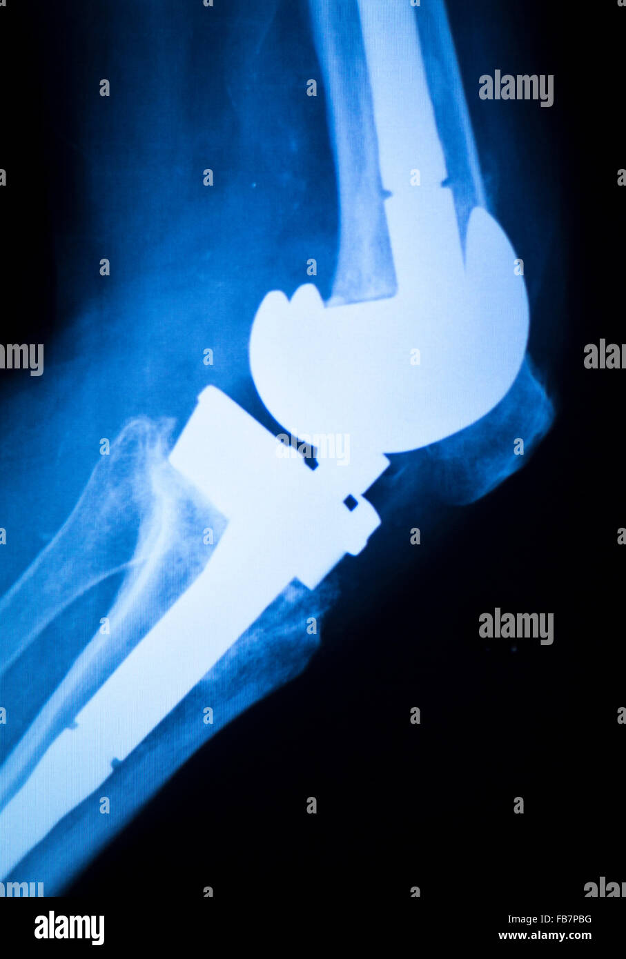 Knee joint meniscus x-ray test scan results photo showing injury and ...