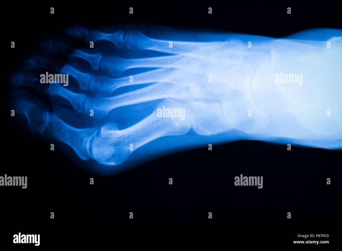 Foot and toes injury x-ray scan orthopedics and Traumatology radiology ...