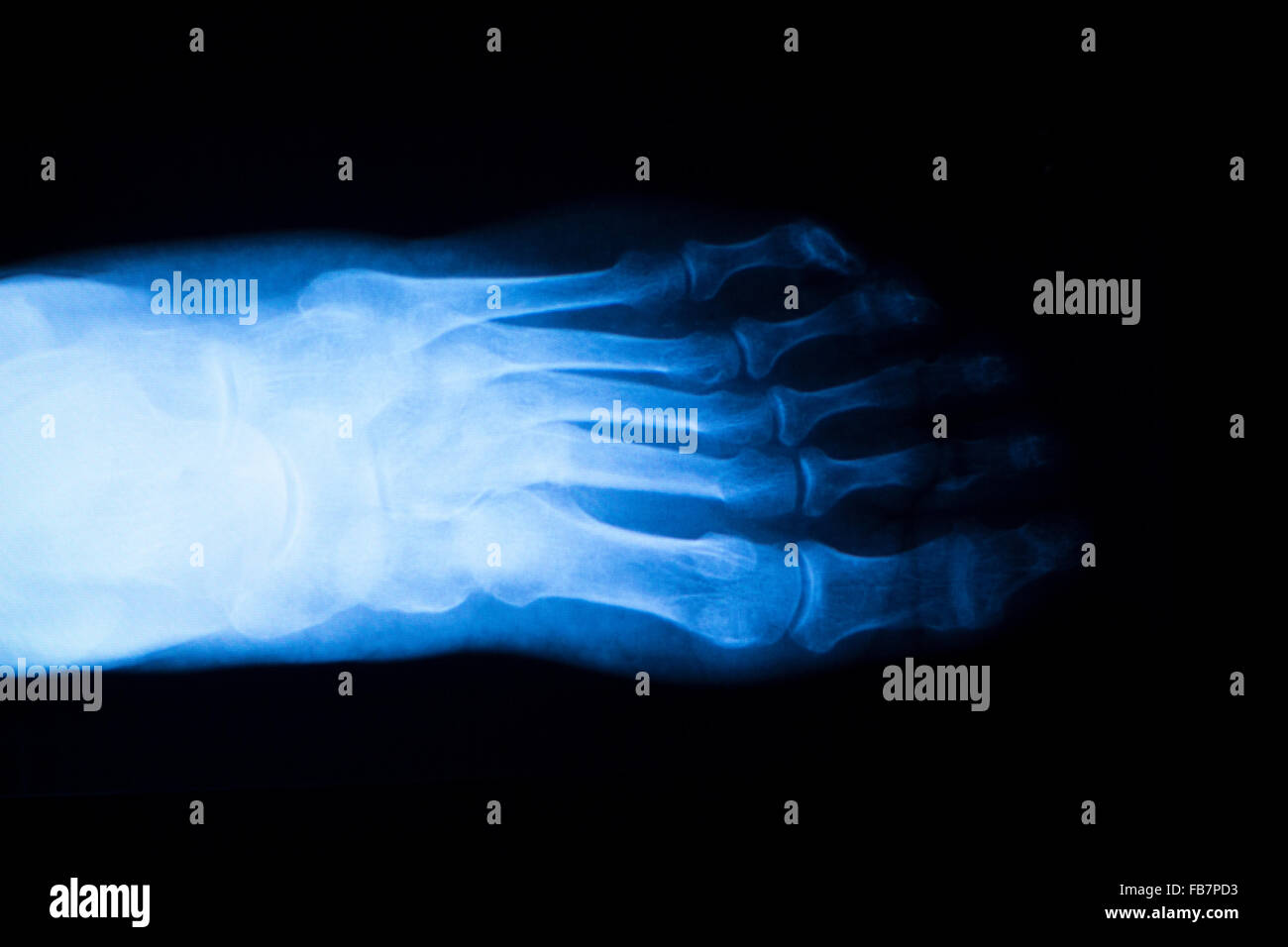 Foot and toes injury x-ray scan orthopedics and Traumatology radiology ...