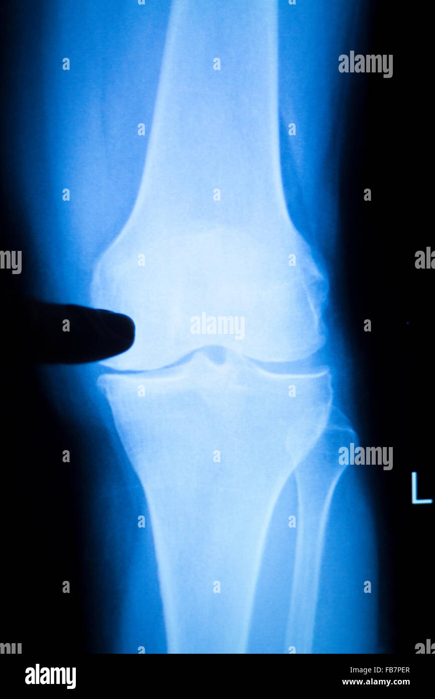 Knee joint meniscus x-ray test scan results photo showing injury and ...