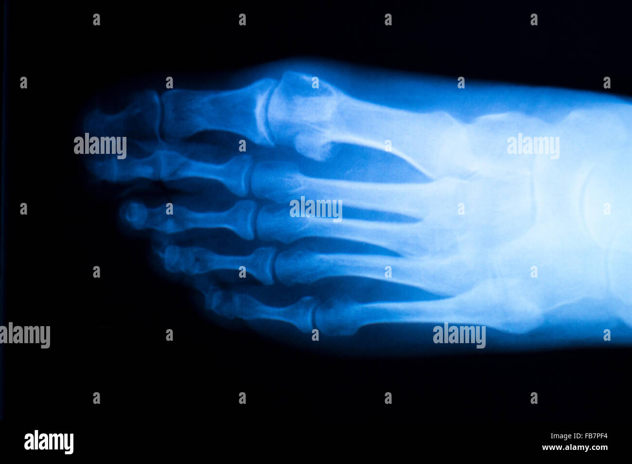 Foot and toes injury x-ray scan orthopedics and Traumatology radiology ...