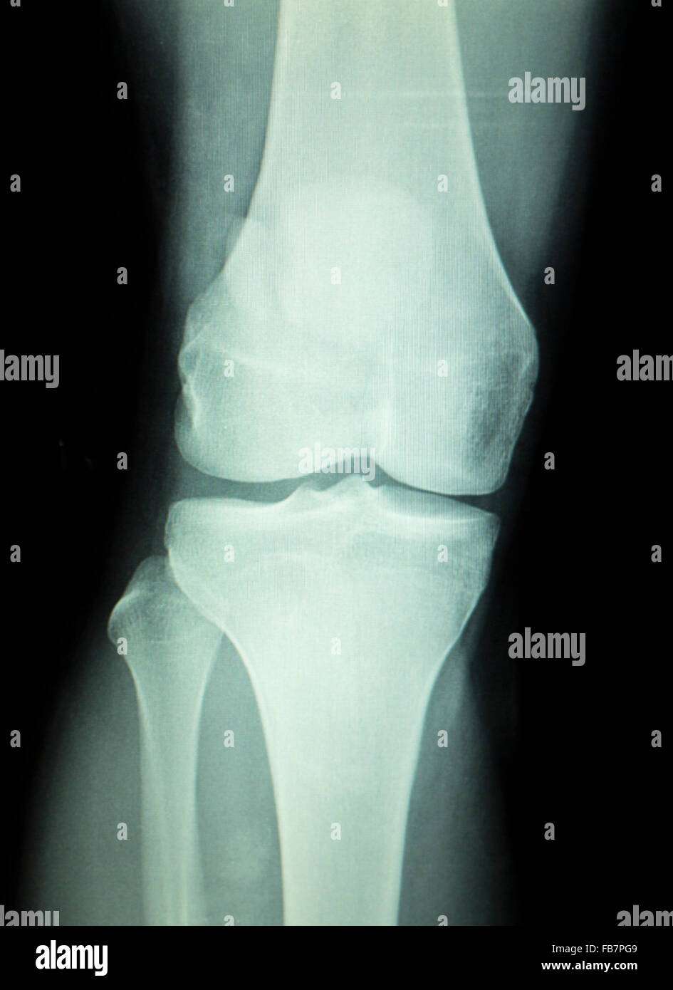 Knee joint meniscus x-ray test scan results photo showing injury and ...