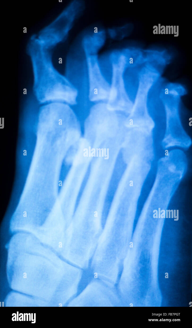 Foot and toes injury x-ray scan orthopedics and Traumatology radiology ...
