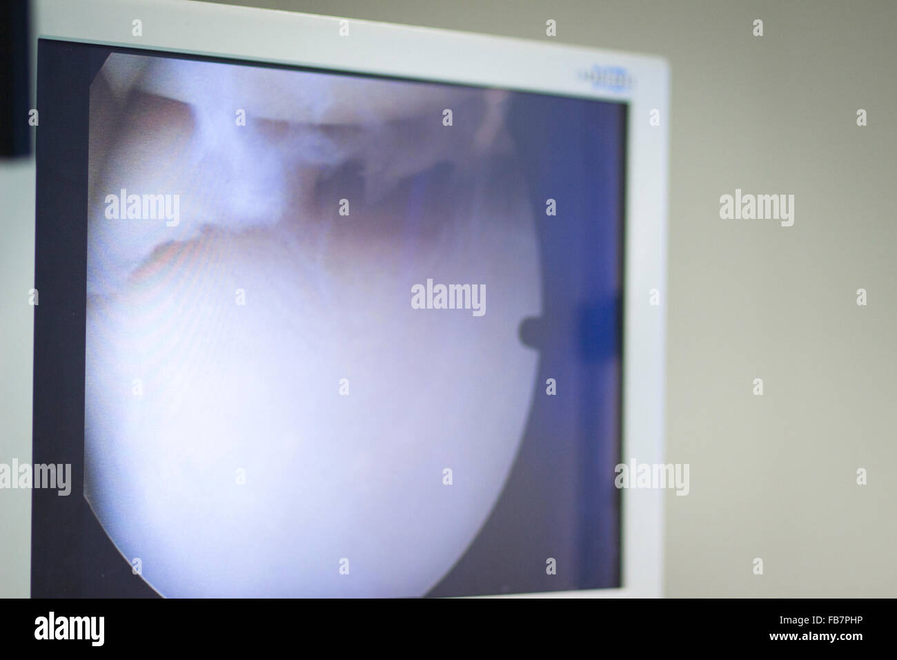 Hospital keyhole micro surgery arthroscopy operation screen showing ...