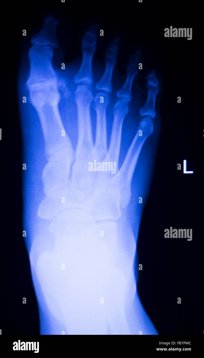 Foot and toes injury x-ray scan orthopedics and Traumatology radiology ...