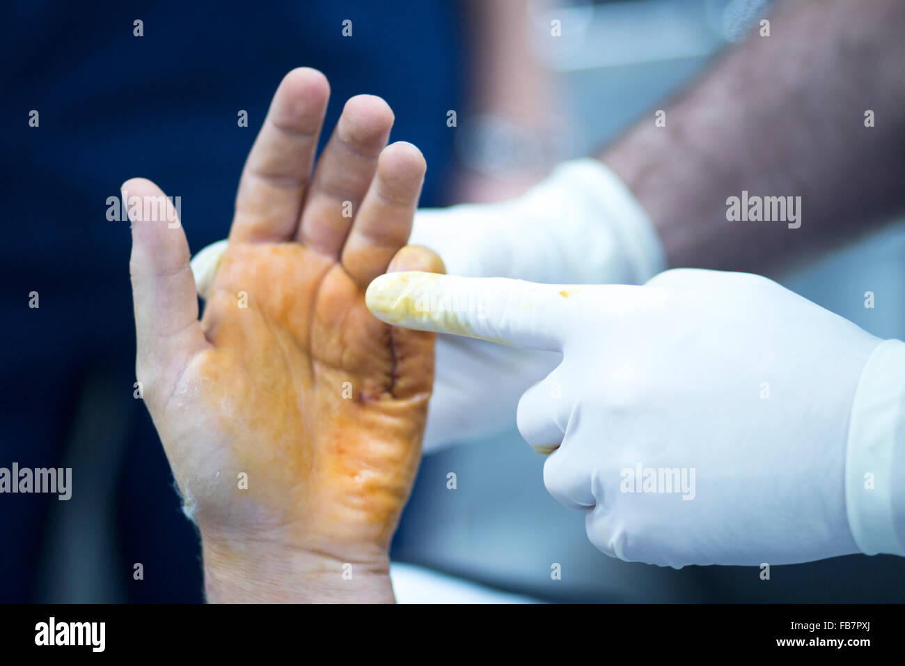 Hospital hand surgery orthopedics operation photo Stock Photo - Alamy