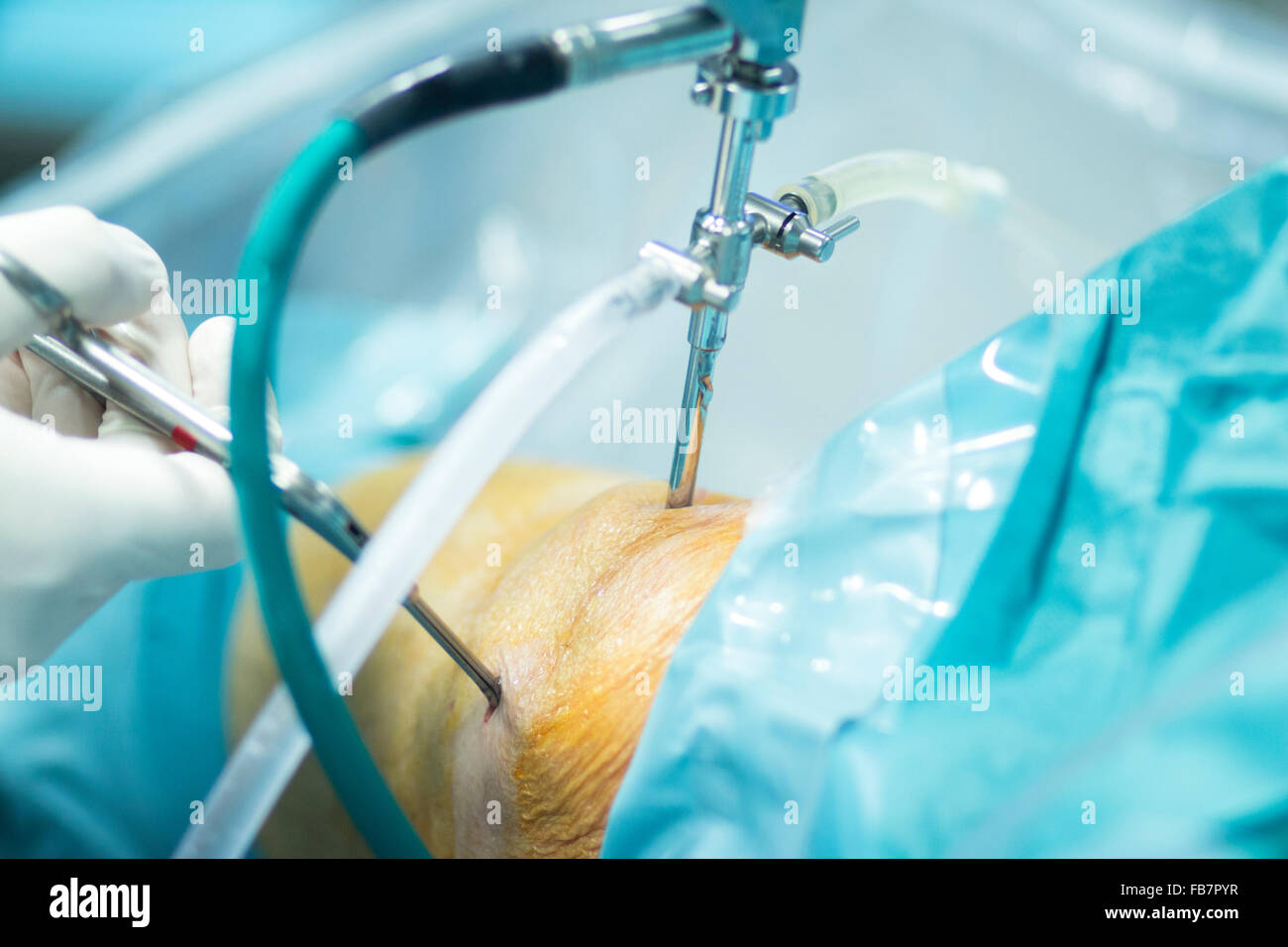 Hospital orthopedics Traumatology surgical operation on torn meniscus ...