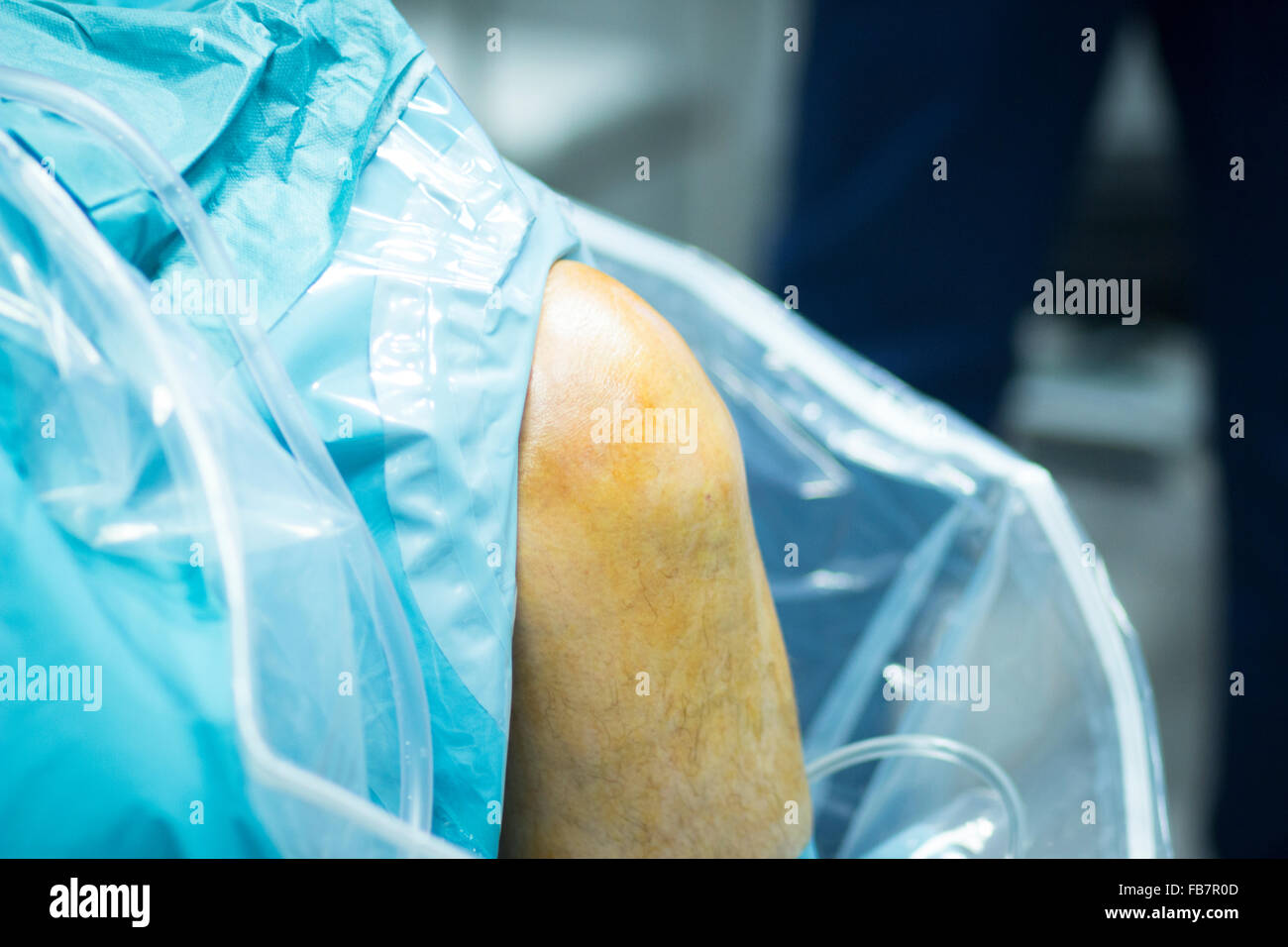 Hospital orthopedic traumatology leg surgery operating room photo Stock ...