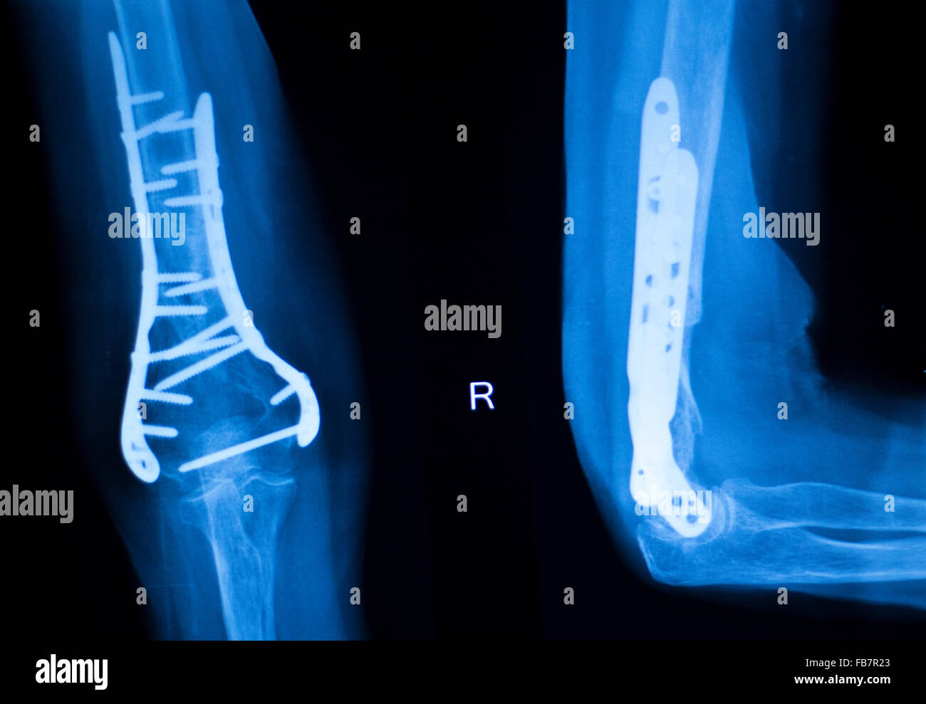 Othopedics and Traumatology surgical implant arm and elbow xray test ...