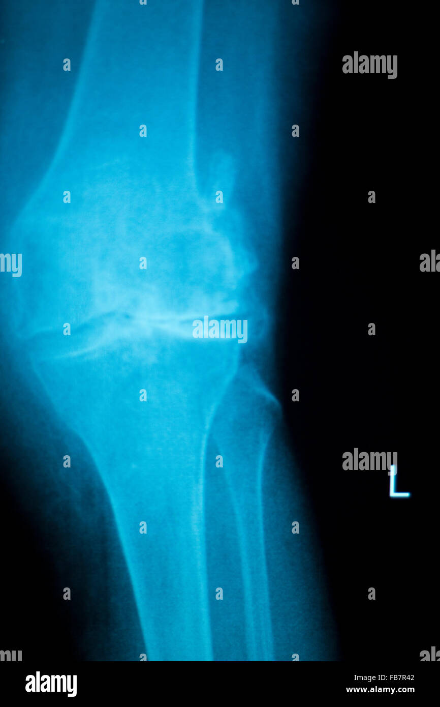 Knee joint meniscus x-ray test scan results photo showing injury and ...