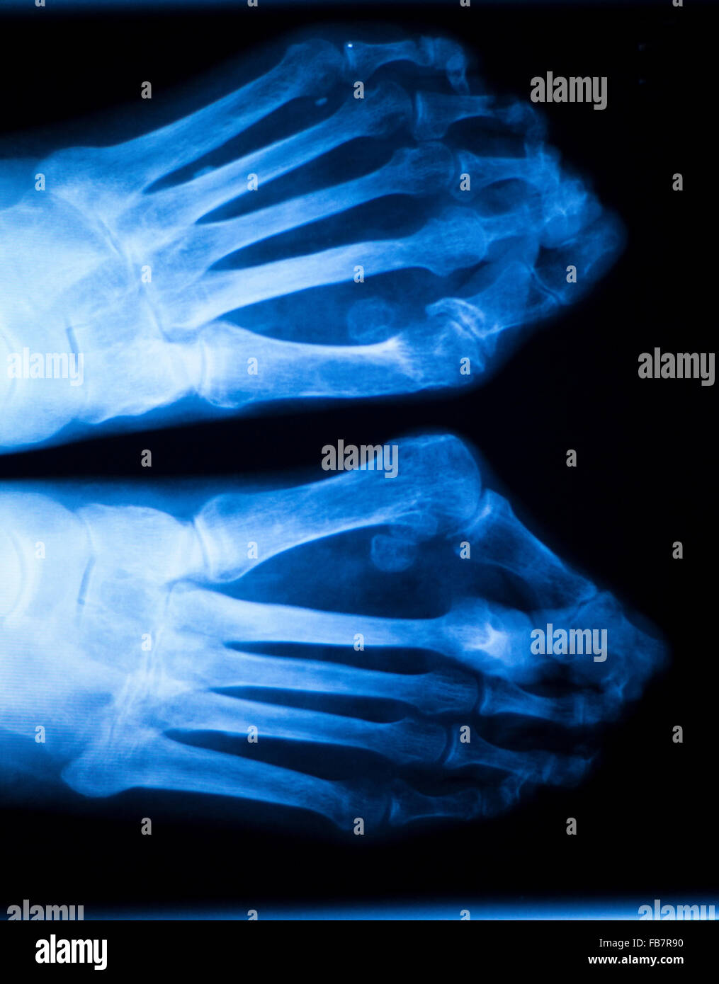 Foot and toes injury x-ray scan orthopedics and Traumatology radiology ...