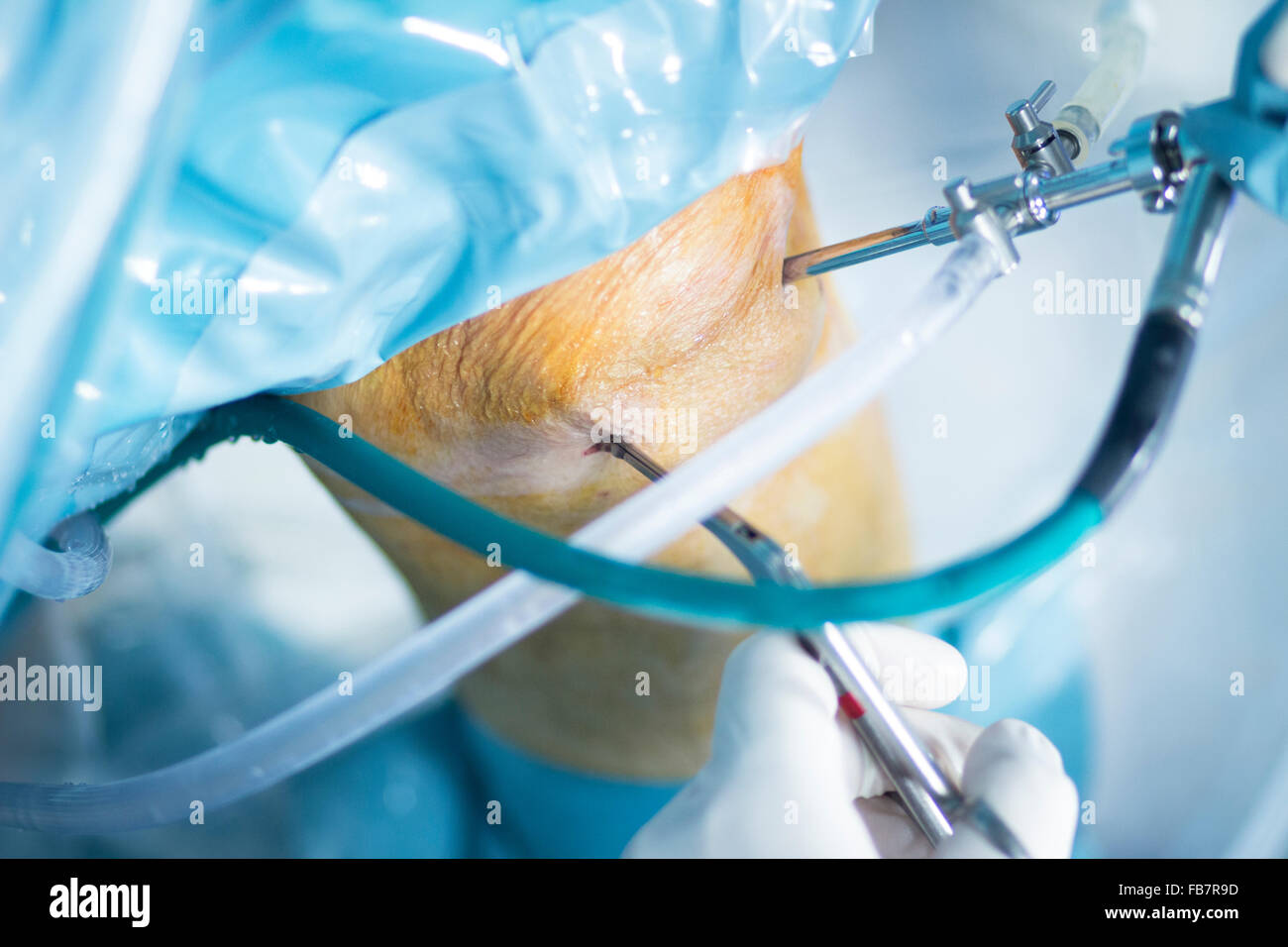 Hospital orthopedics Traumatology surgical operation on torn meniscus ...