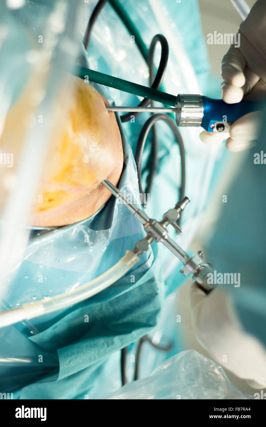 Knee arthroscopy orthopedic surgery operation in hospital operating ...