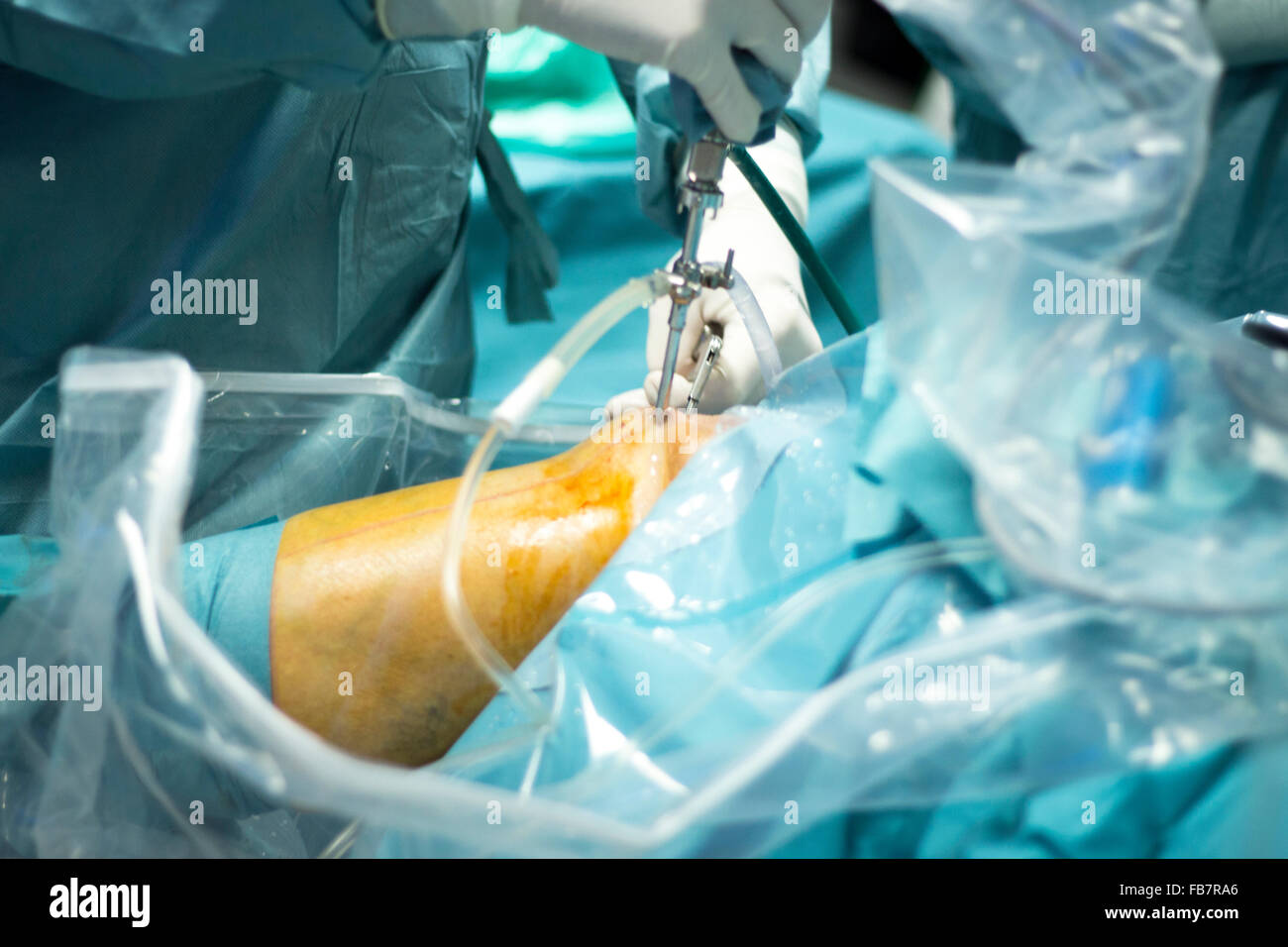 Knee arthroscopy orthopedic surgery operation in hospital operating ...