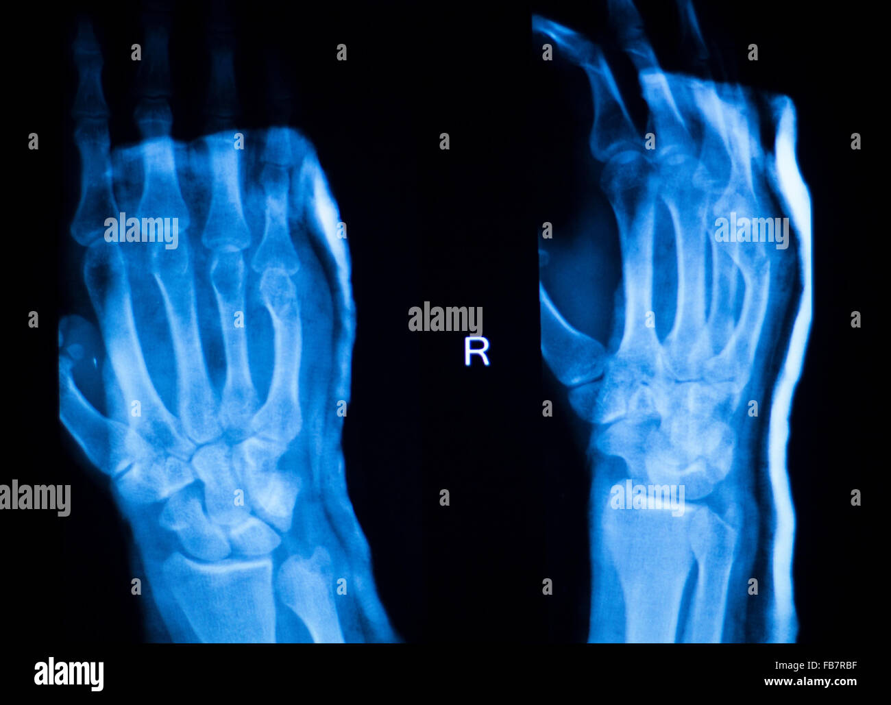 Hand, fingers and thumb hospital x-ray scan test results for joint pain ...