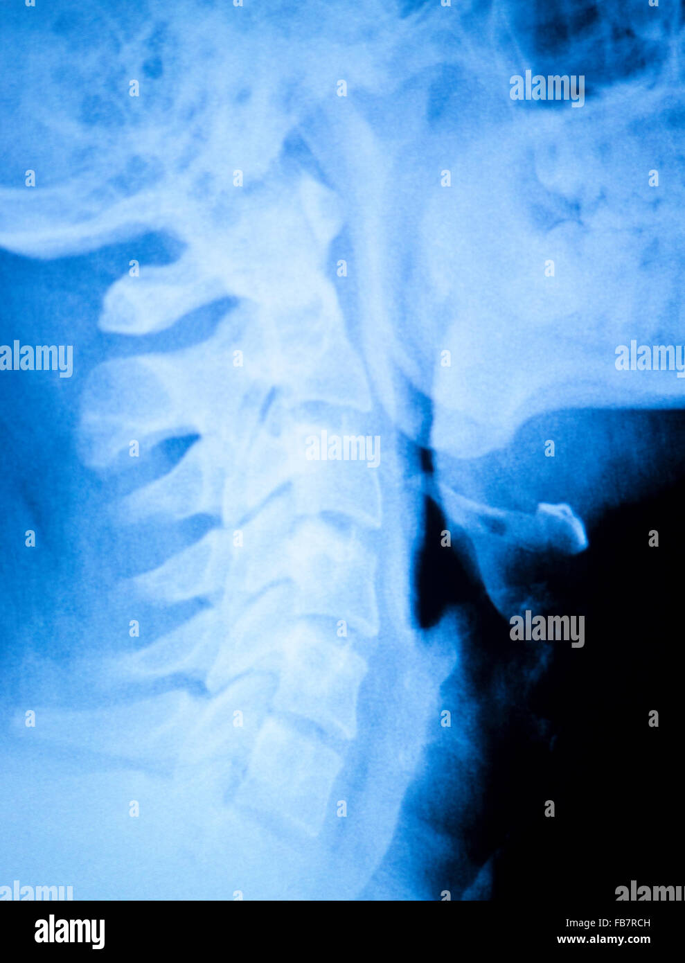Painful neck and spine injury x-ray scan Traumatology and orthopedics ...