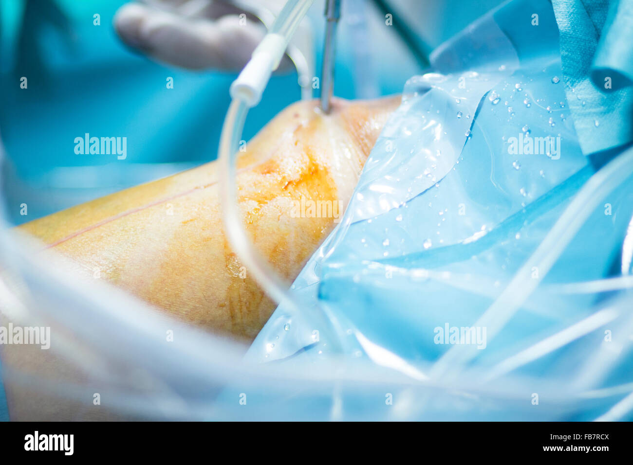 Orthopedics knee surgery Traumatology hospital surgical operation photo ...