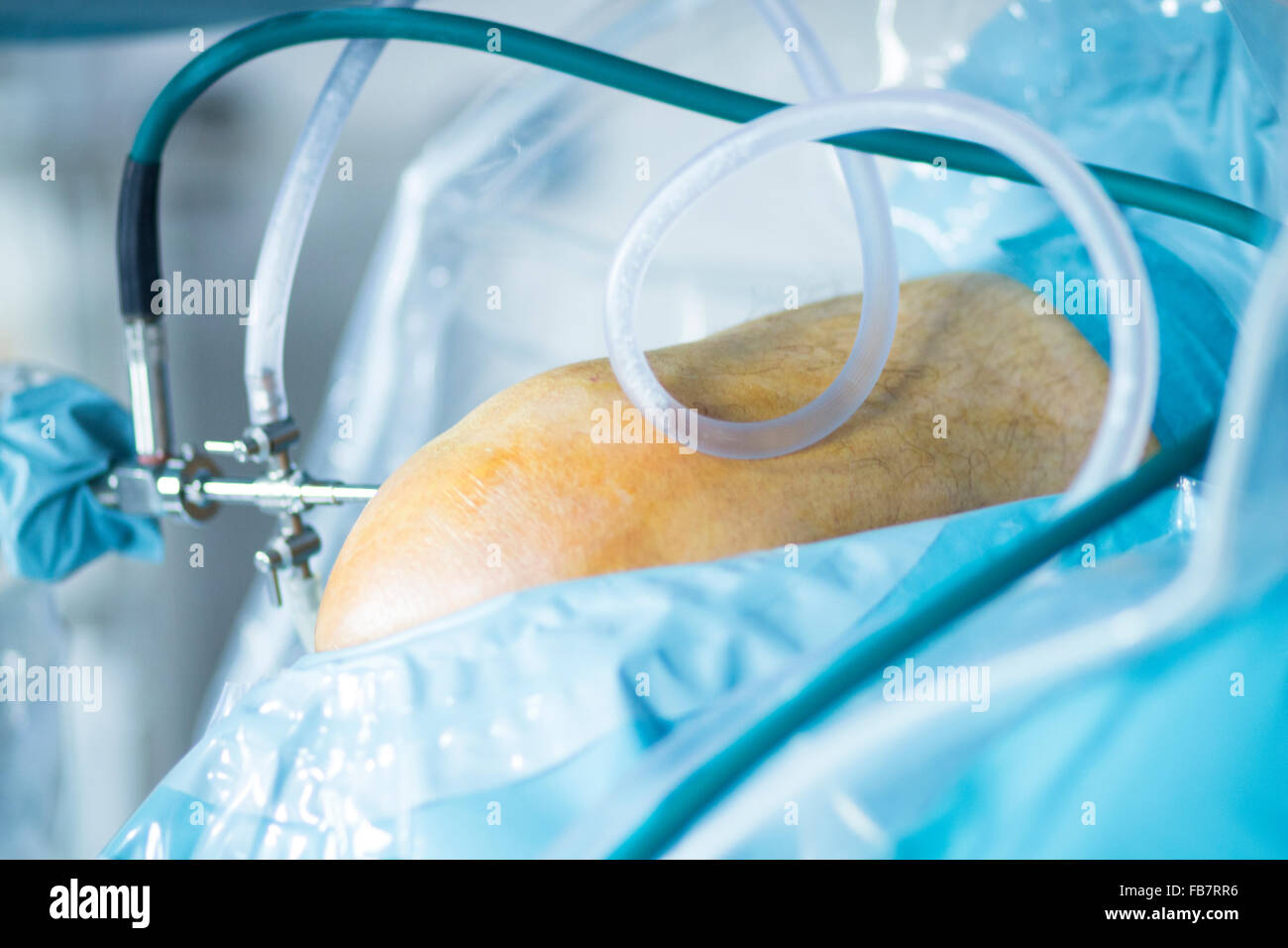 Hospital orthopedics Traumatology surgical operation on torn meniscus ...