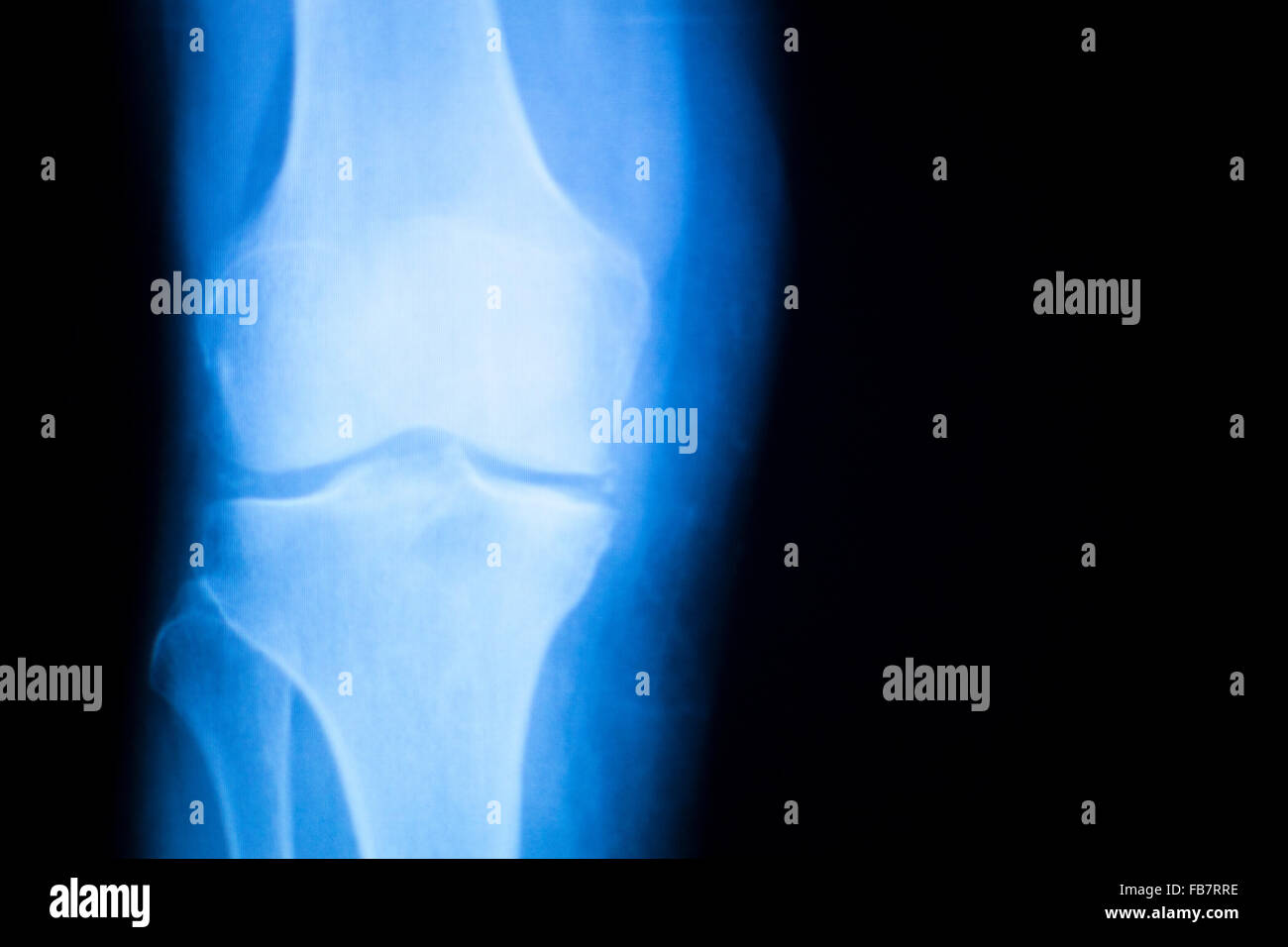 Knee joint meniscus x-ray test scan results photo showing injury and ...