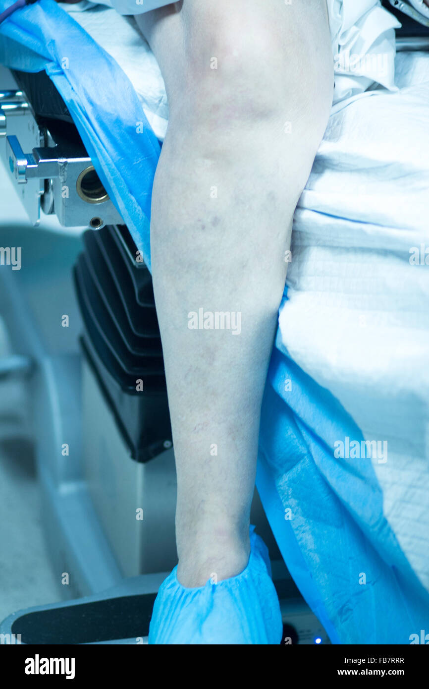 Arthroscope arthroscopy arthroscopic hi-res stock photography and ...