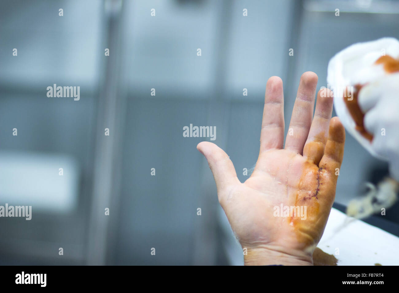 Hospital hand surgery orthopedics operation photo Stock Photo - Alamy