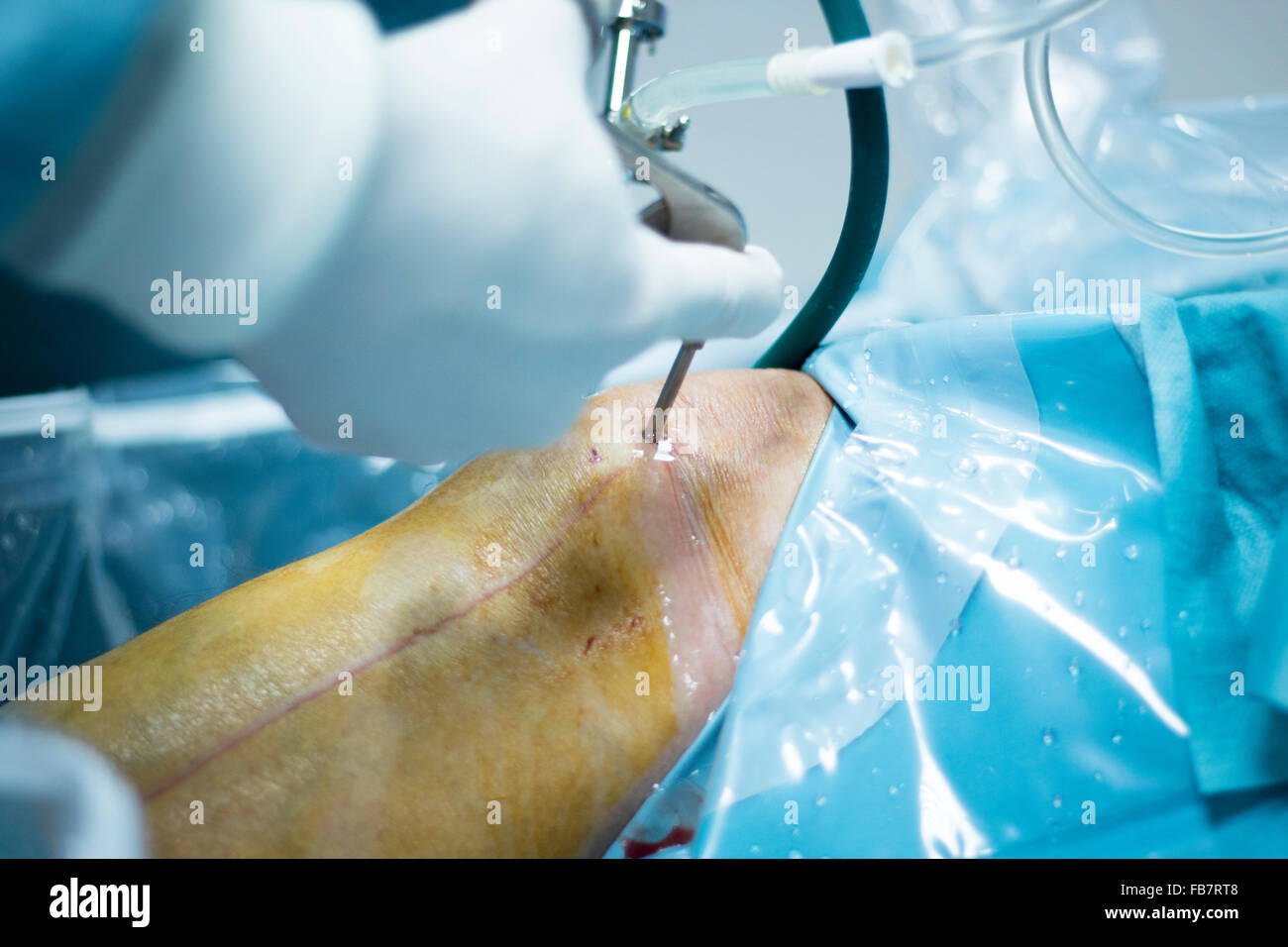 Knee arthroscopy orthopedic surgery operation in hospital operating ...