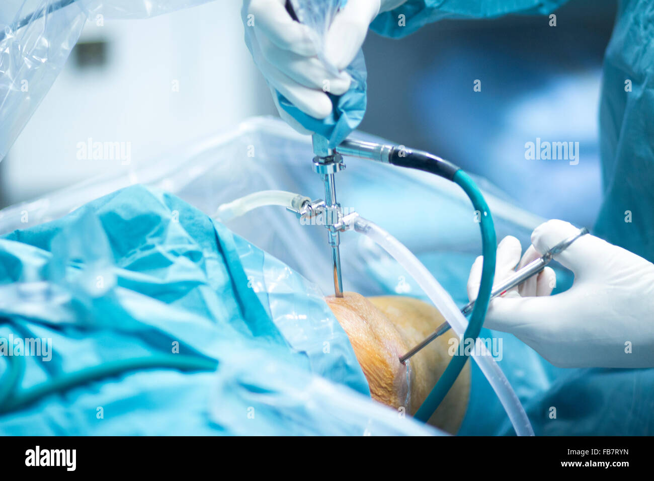 Hospital orthopedics Traumatology surgical operation on torn meniscus ...