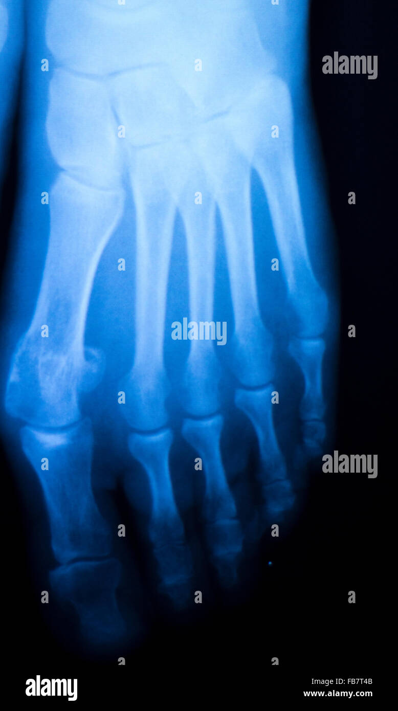 Foot and toes injury x-ray scan orthopedics and Traumatology radiology ...