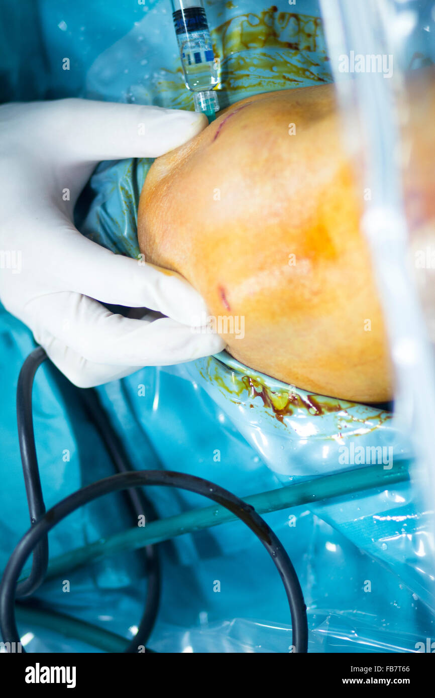 Orthopedic surgery meniscus operation hospital emergency operating room ...