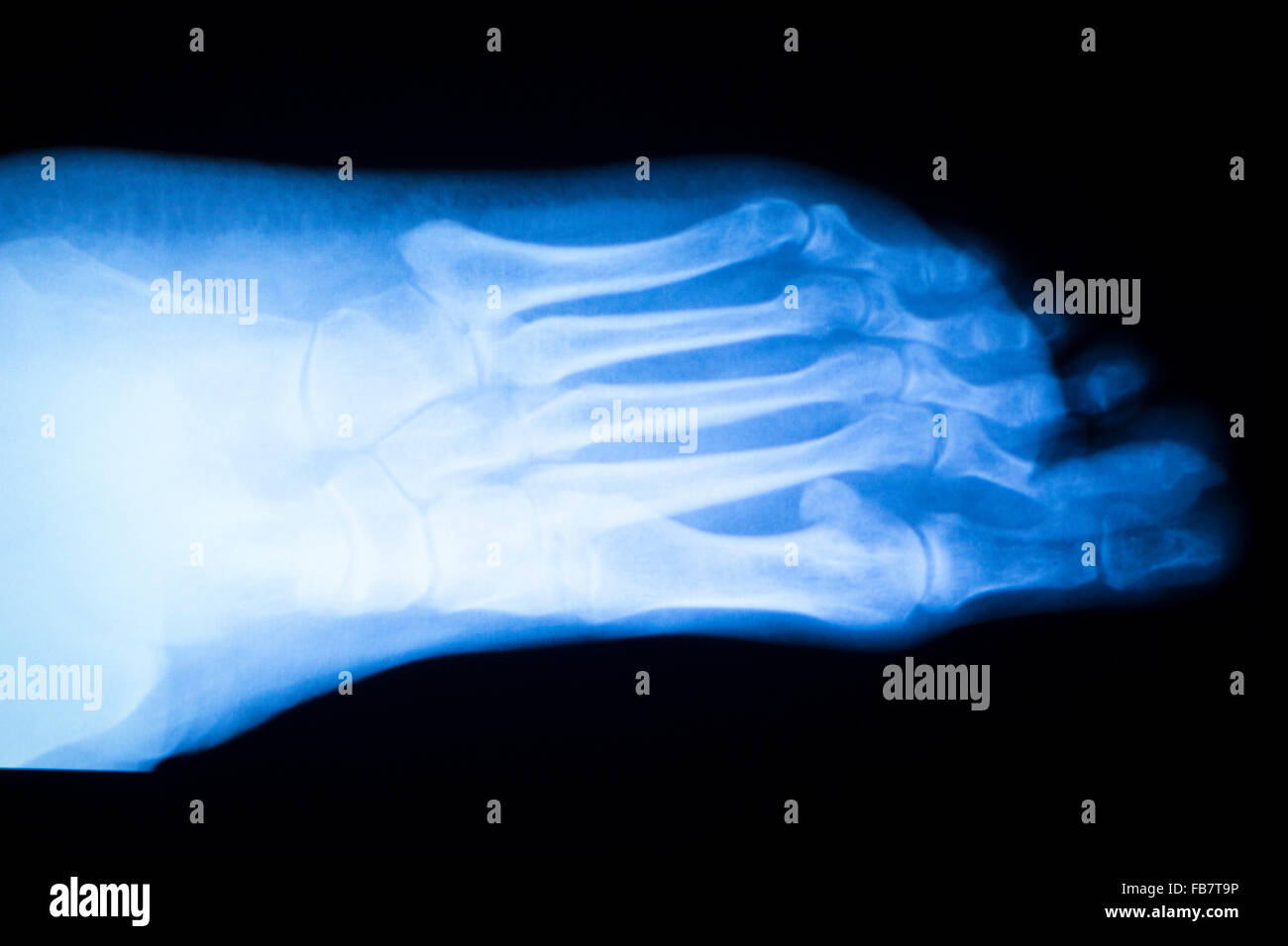 Foot and toes injury x-ray scan orthopedics and Traumatology radiology ...