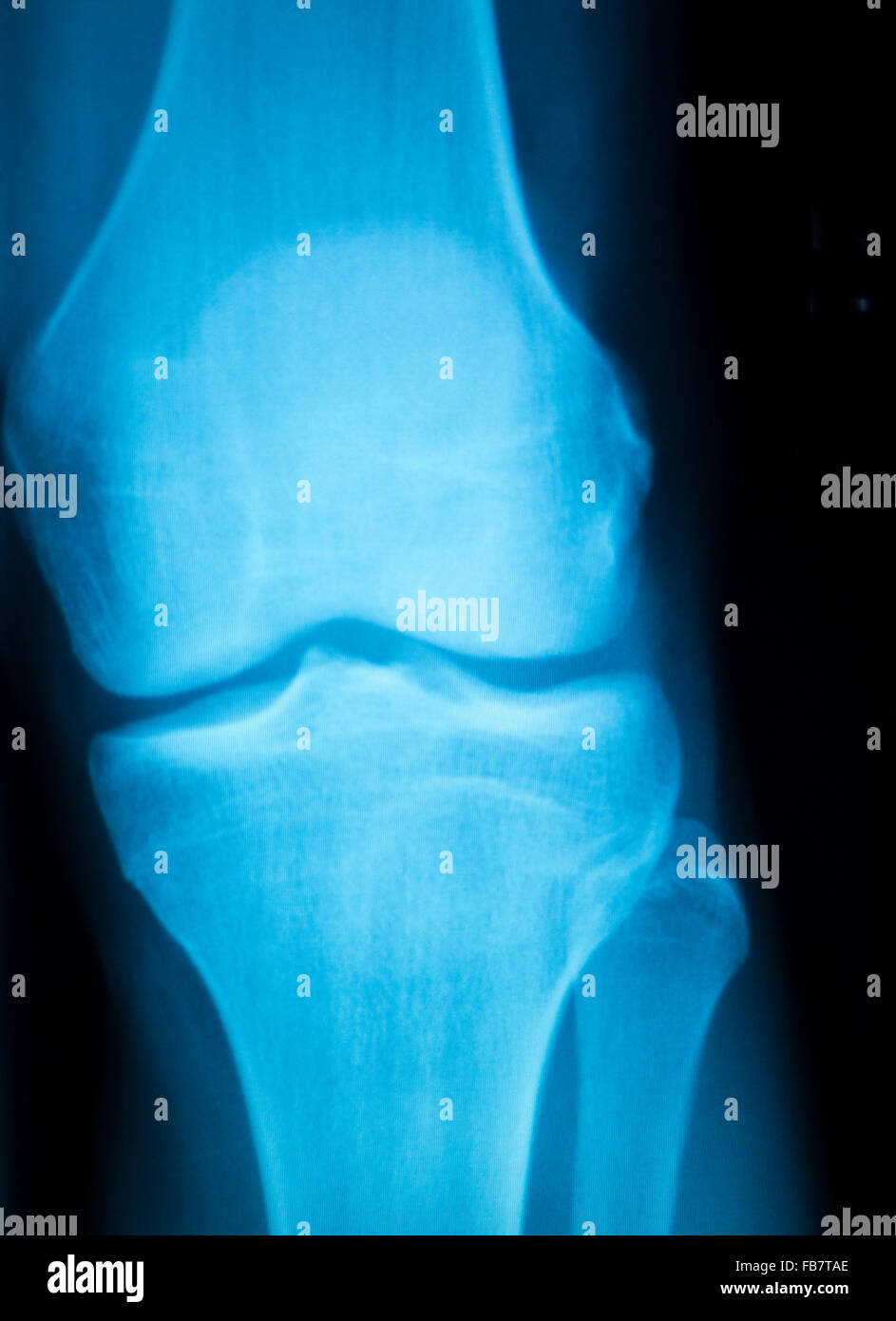 Knee joint meniscus x-ray test scan results photo showing injury and ...