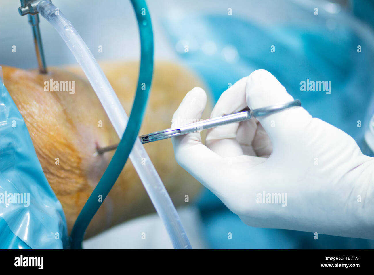 Hospital orthopedics Traumatology surgical operation on torn meniscus ...