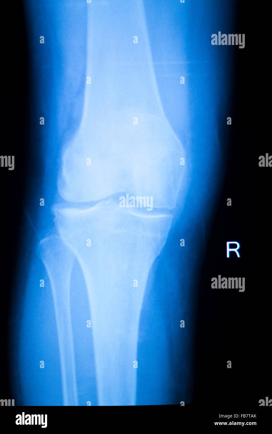 Knee joint meniscus x-ray test scan results photo showing injury and ...