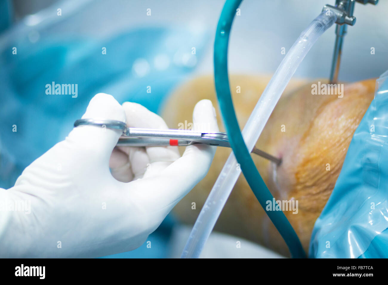 Hospital orthopedics Traumatology surgical operation on torn meniscus ...