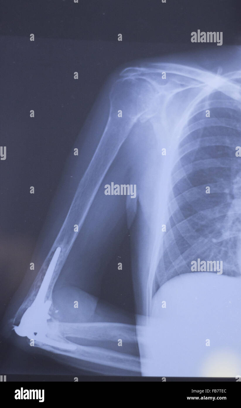 Othopedics and Traumatology surgical implant arm and elbow xray test ...