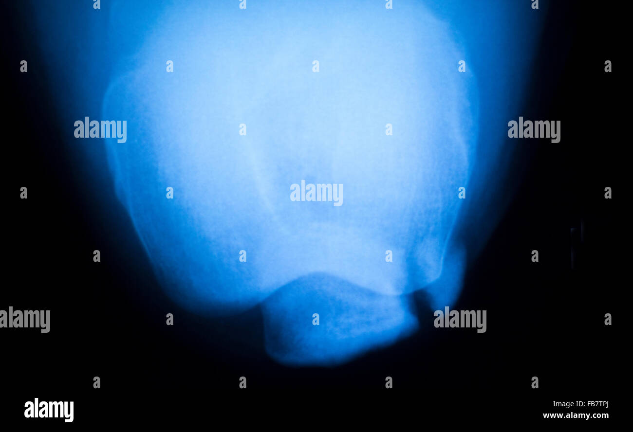 Knee joint meniscus x-ray test scan results photo showing injury and ...