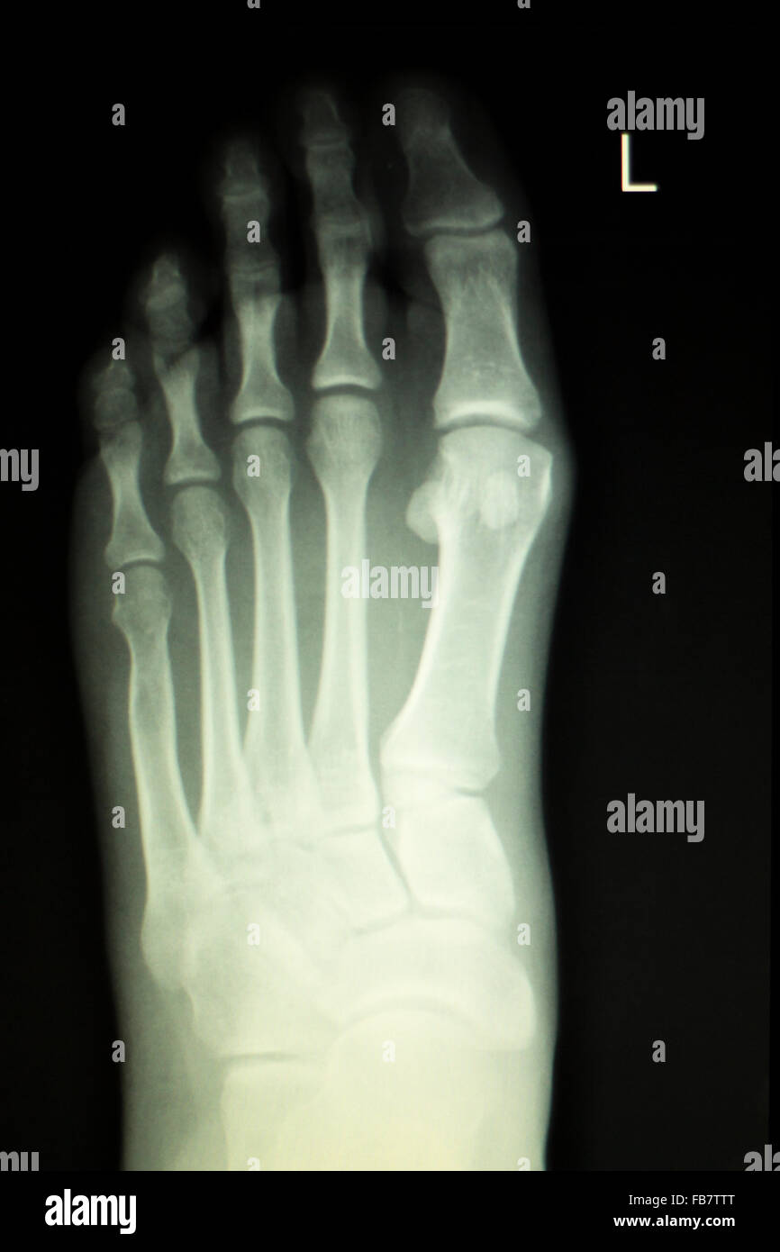 Foot and toes injury x-ray scan orthopedics and Traumatology radiology ...