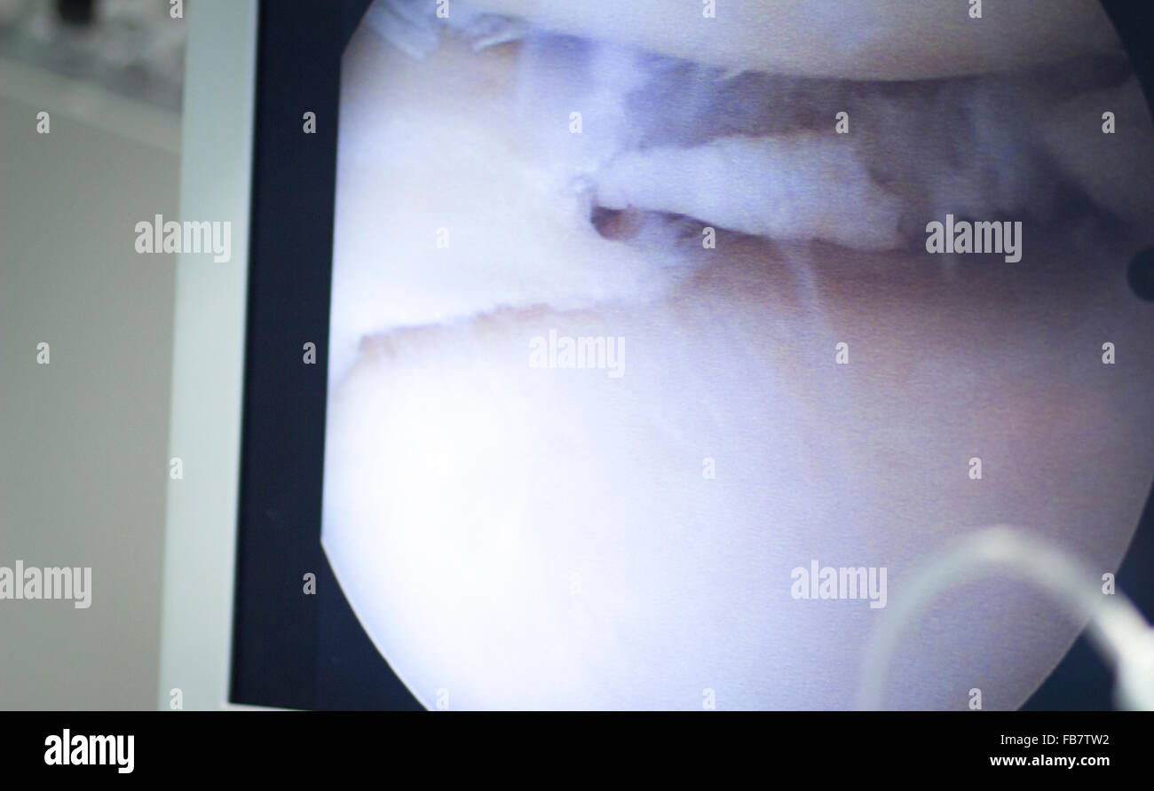 Hospital keyhole micro surgery arthroscopy operation screen showing ...