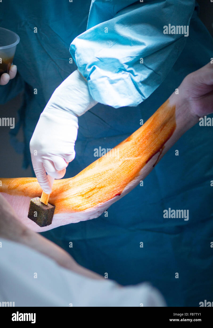 Hospital elbow surgery emergency orthopedics arm operation operating ...