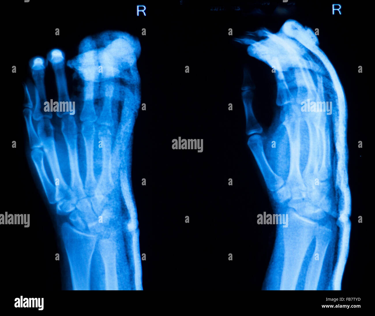 Hand, fingers and thumb hospital x-ray scan test results for joint pain ...