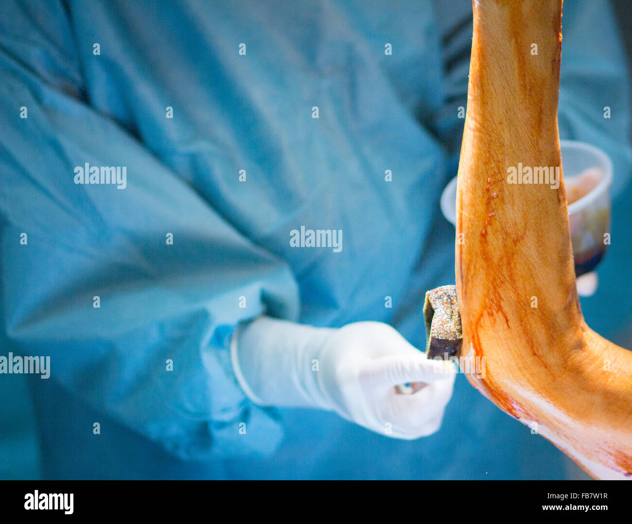 Hospital elbow surgery emergency orthopedics arm operation operating ...