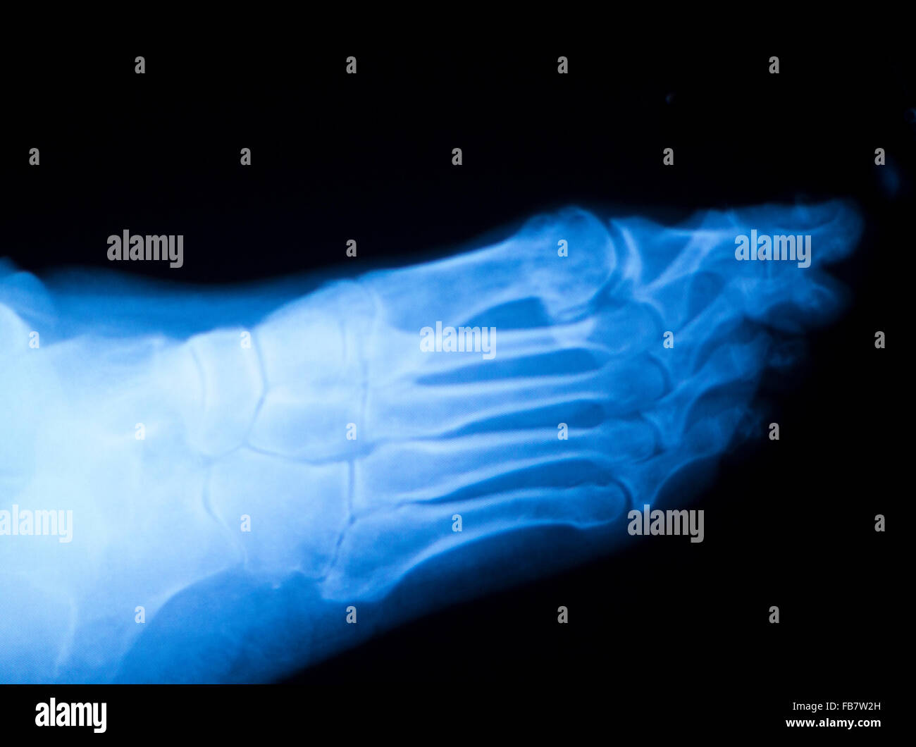 Foot and toes injury x-ray scan orthopedics and Traumatology radiology ...