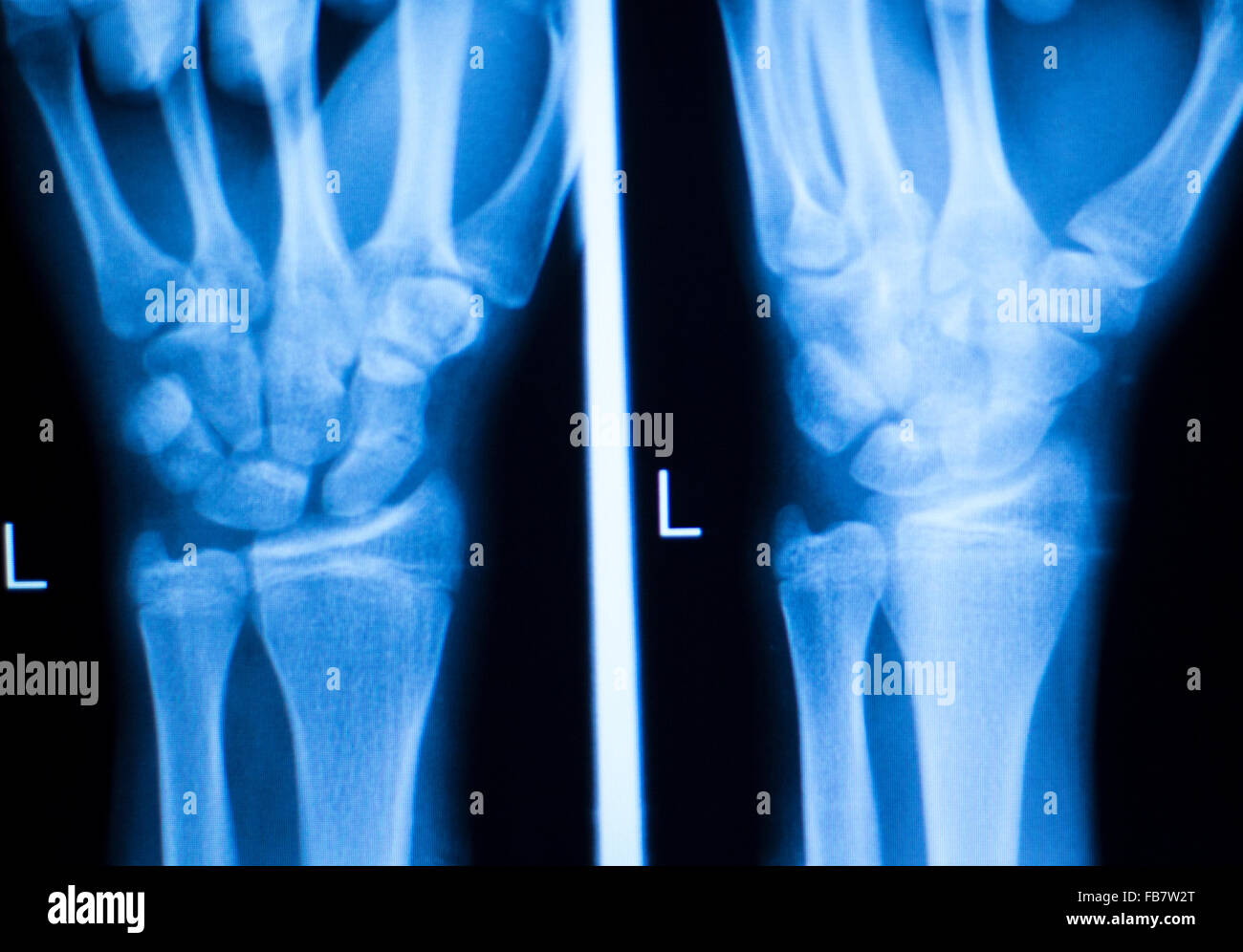 Hand, fingers and thumb hospital x-ray scan test results for joint pain ...